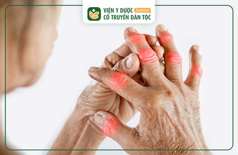 Bệnh Gout Mãn Tính Là Gì? Có Nguy Hiểm Không? Cách Chữa